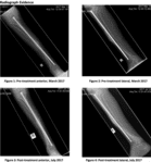 Evidence of Bone Repair Using Matrix Repatterning A Case Report ...